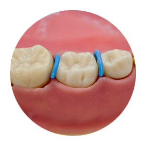 Separators | JK Orthodontics